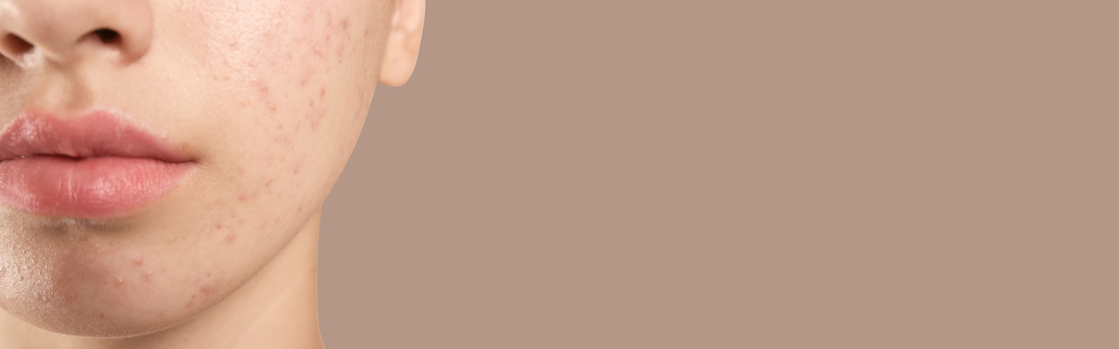 Cicatrices Bouton d'Acné Visage : Que faire ? 4 traitements | Epilium ...