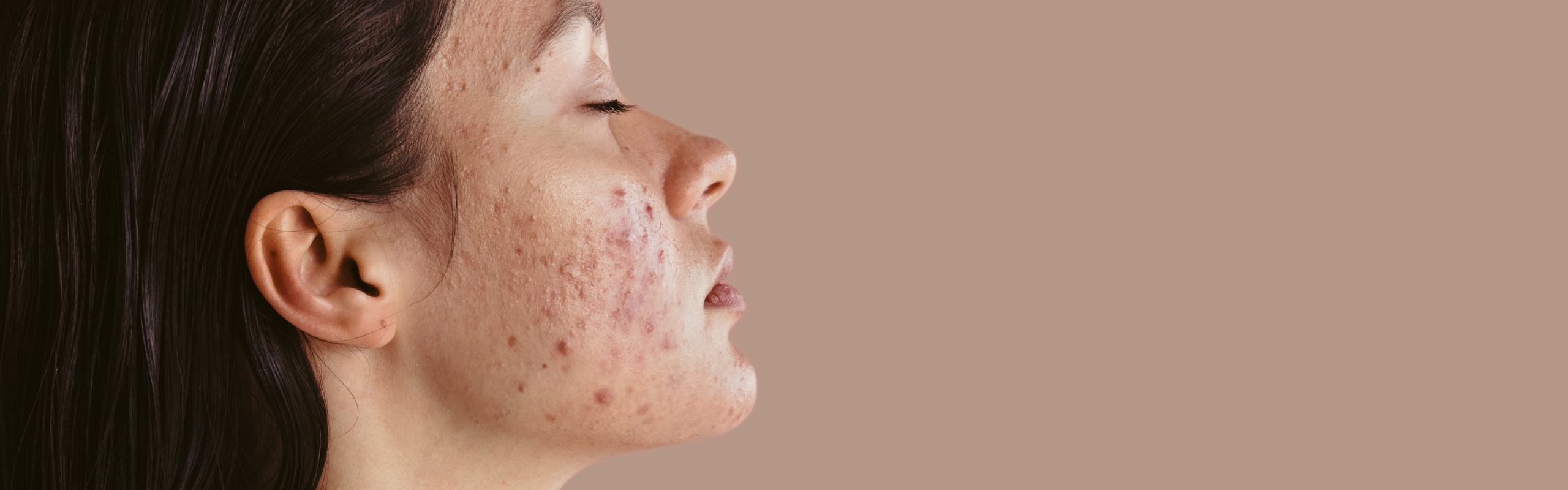 Traitement Acné - Epilium & Skin Paris